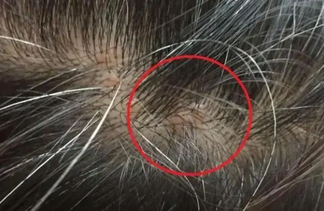 Why Does Your Scalp Frequently Develop Pustules and Swelling? Doctor ...