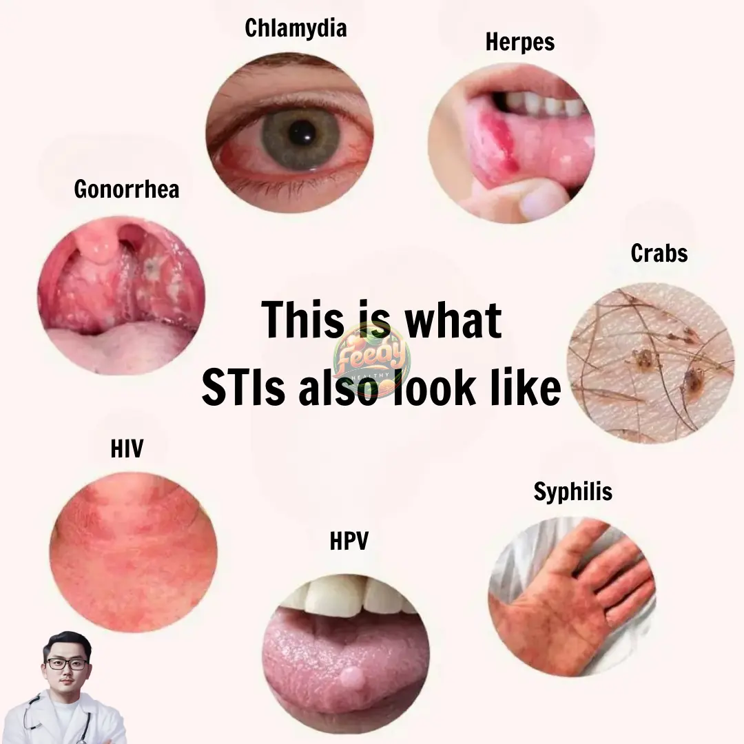 Sexually Transmitted Infections (STIs): Everything You Need to Know to Protect Your Intimate Health